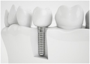 Osseointegration of Dental Implants - Piney Point Oral & Maxillofacial ...