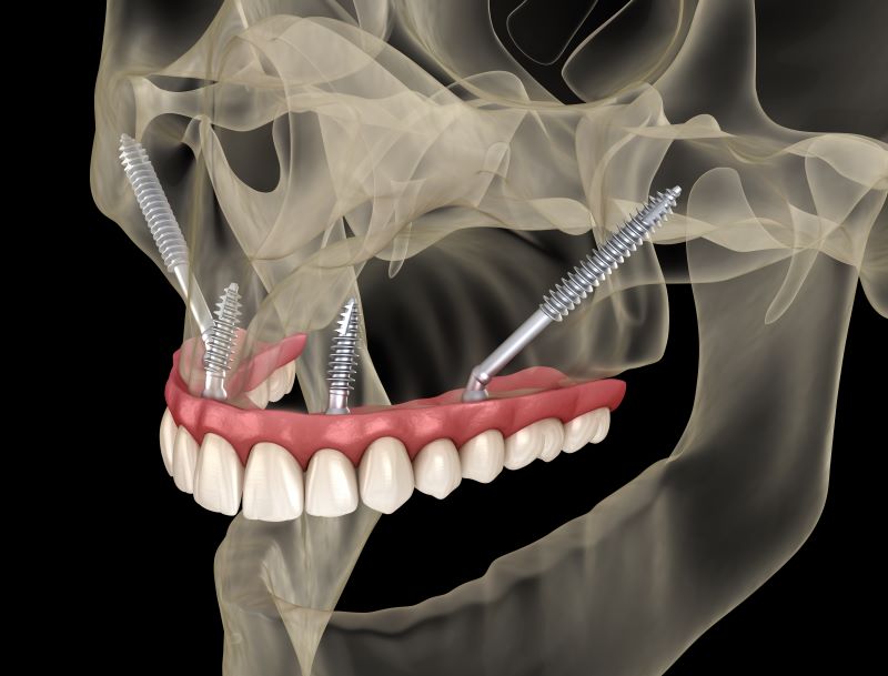 Your Basic Guide to Zygomatic Dental Implants
